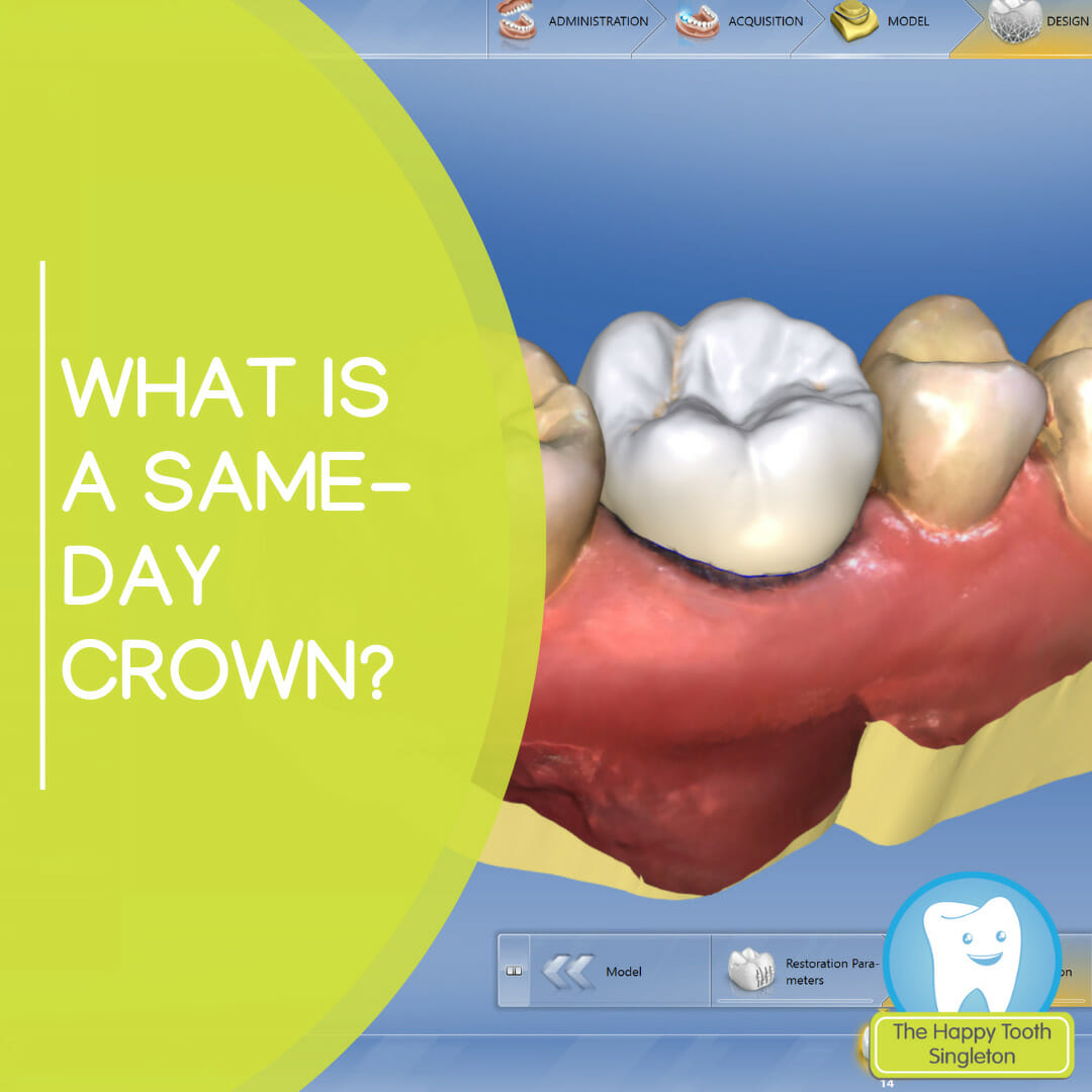 Same Day Crown | The Happy Tooth Singleton