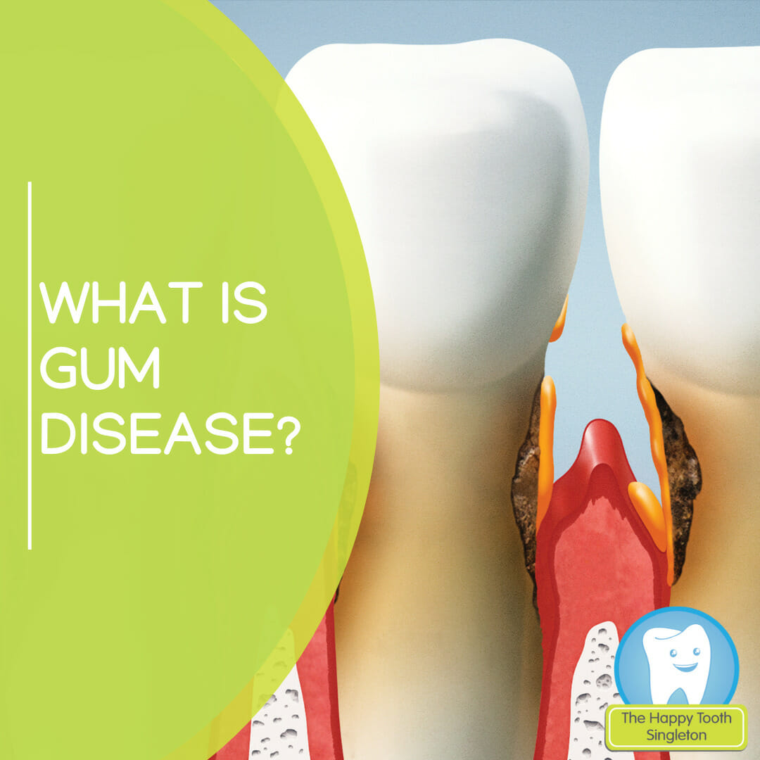 What is Gum Disease? | The Happy Tooth Singleton